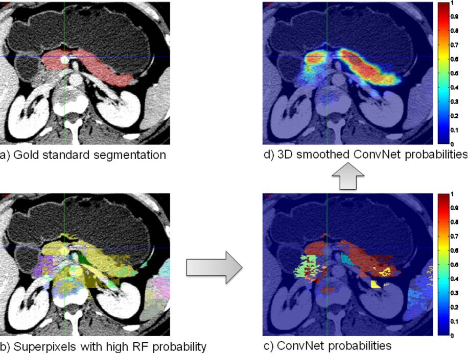 Deep convolutional networks for pancreas segmentation in CT imaging | DeepAI