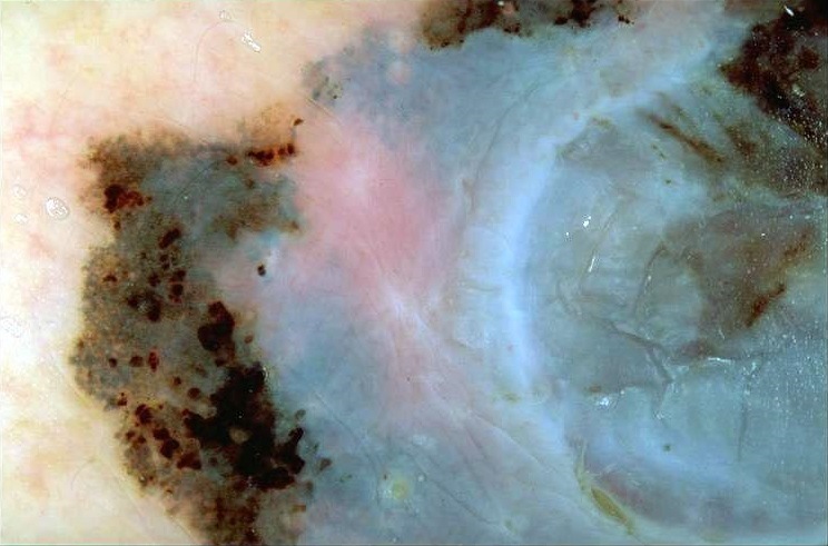 Learning to Detect Blue-white Structures in Dermoscopy Images with Weak ...