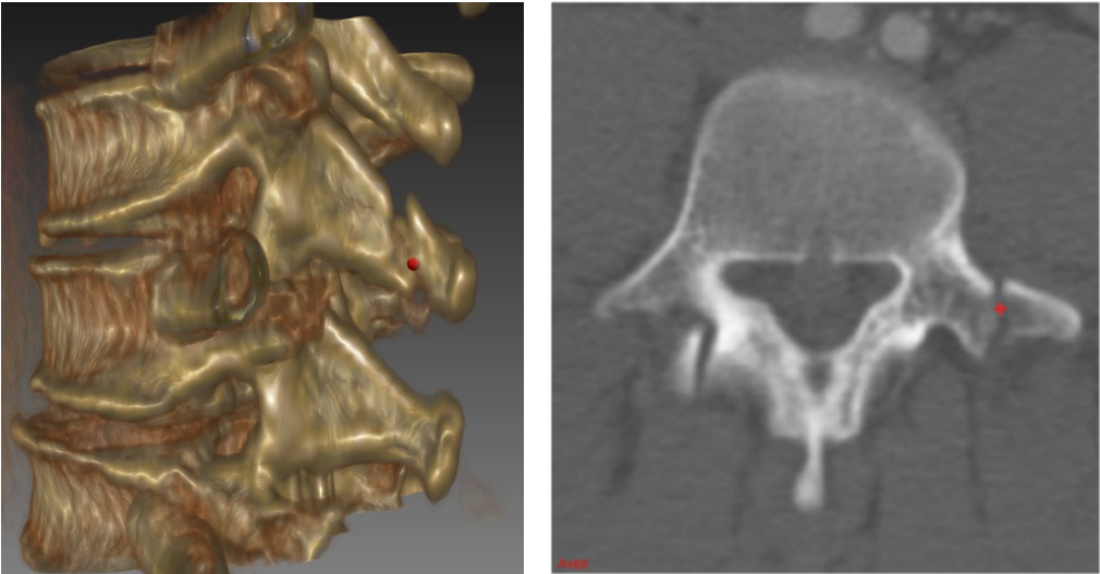 Deep convolutional networks for automated detection of posterior-element fractures on spine CT ...