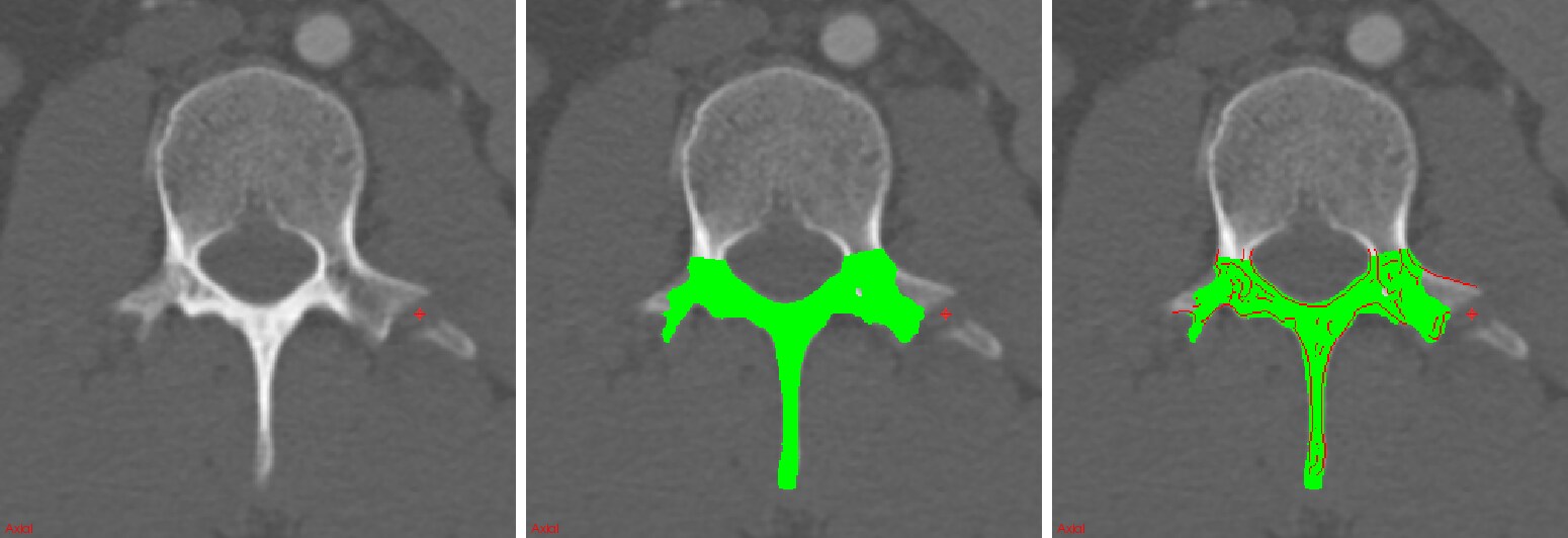 Deep Convolutional Networks For Automated Detection Of Posterior