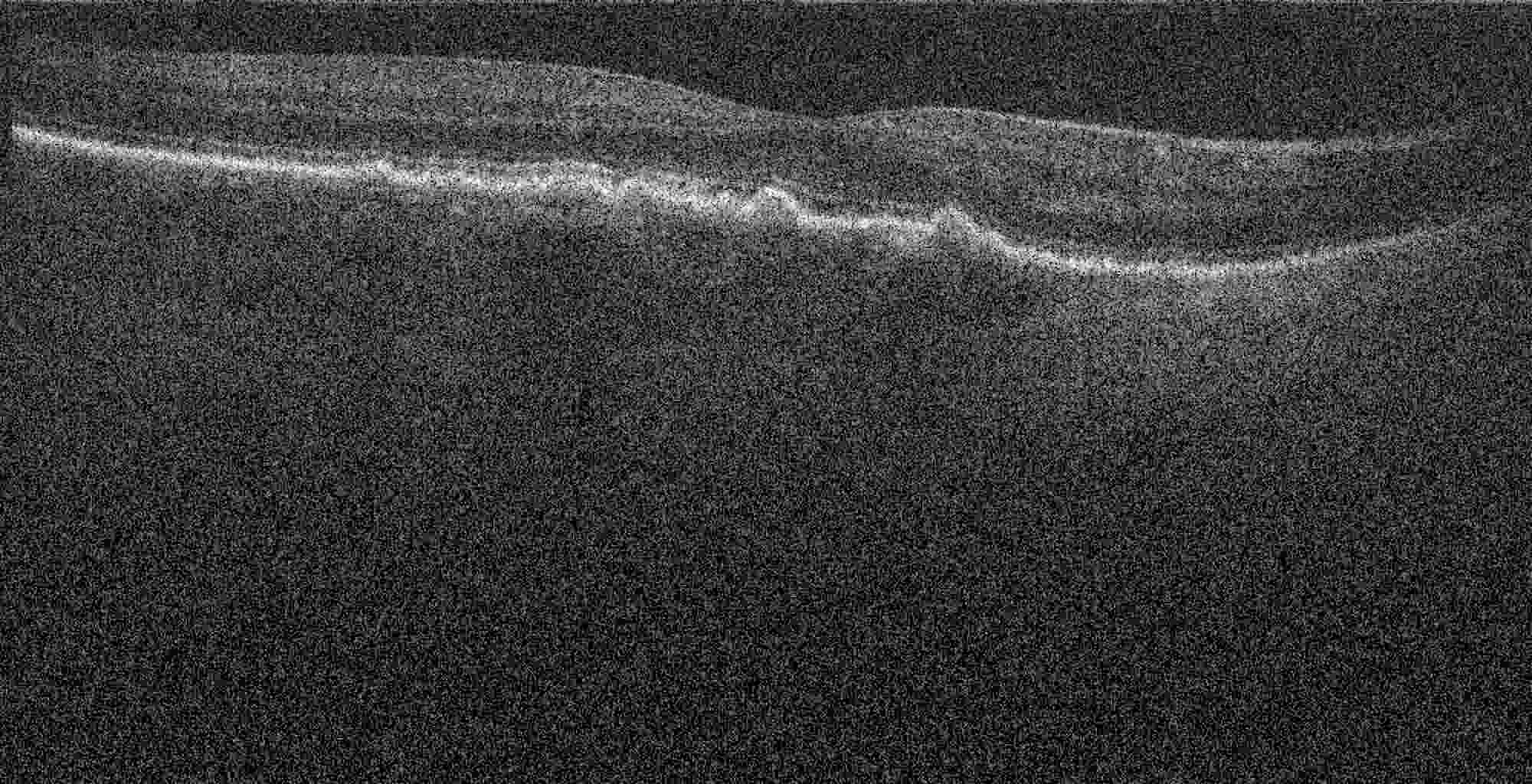 RetiNet: Automatic AMD identification in OCT volumetric data | DeepAI