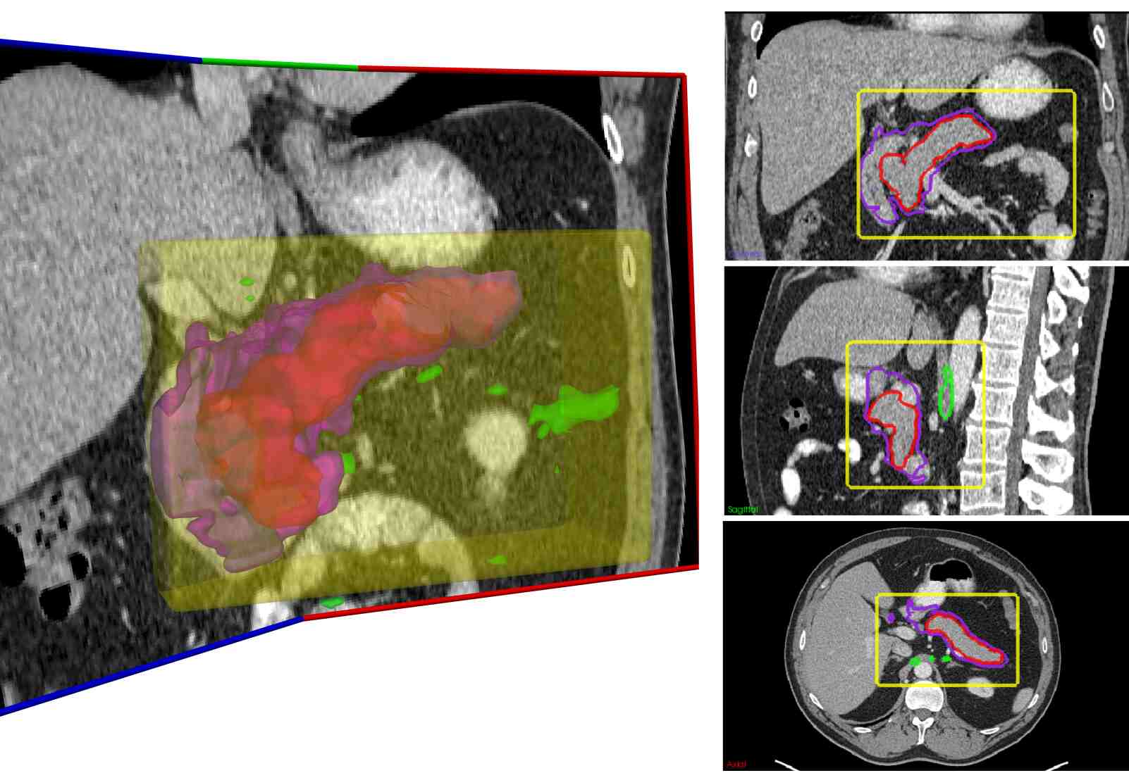 Spatial Aggregation of Holistically-Nested Convolutional Neural Networks for Automated Pancreas ...