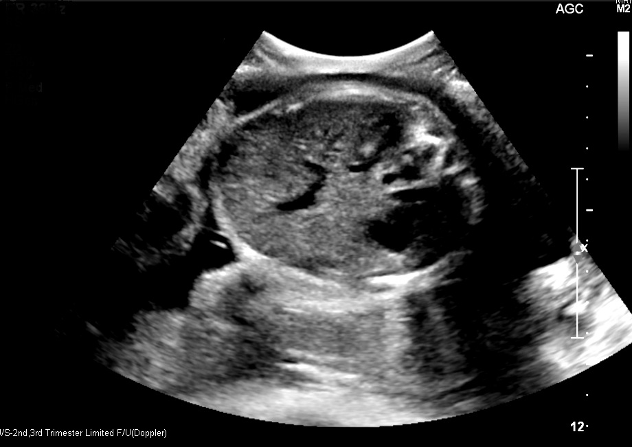 Automatic Estimation of Fetal Abdominal Circumference from Ultrasound ...