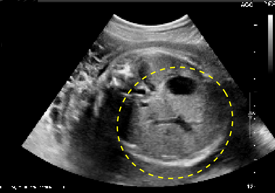 Automatic Estimation of Fetal Abdominal Circumference from Ultrasound ...
