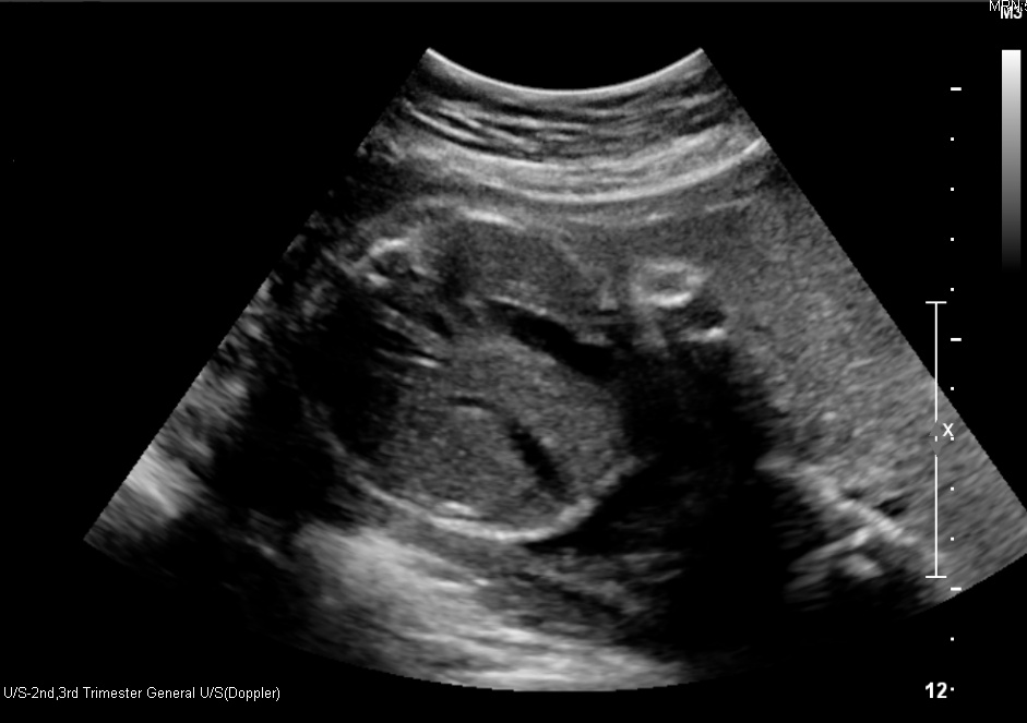 Automatic Estimation of Fetal Abdominal Circumference from Ultrasound ...