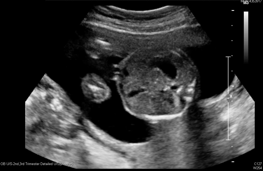 Automatic Estimation of Fetal Abdominal Circumference from Ultrasound ...