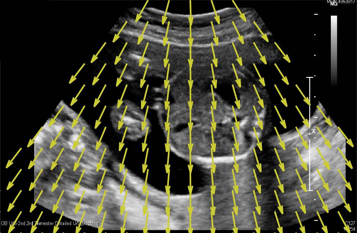 Automatic Estimation of Fetal Abdominal Circumference from Ultrasound ...