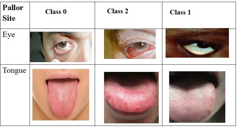 Computer Aided Detection of Anemia-like Pallor | DeepAI