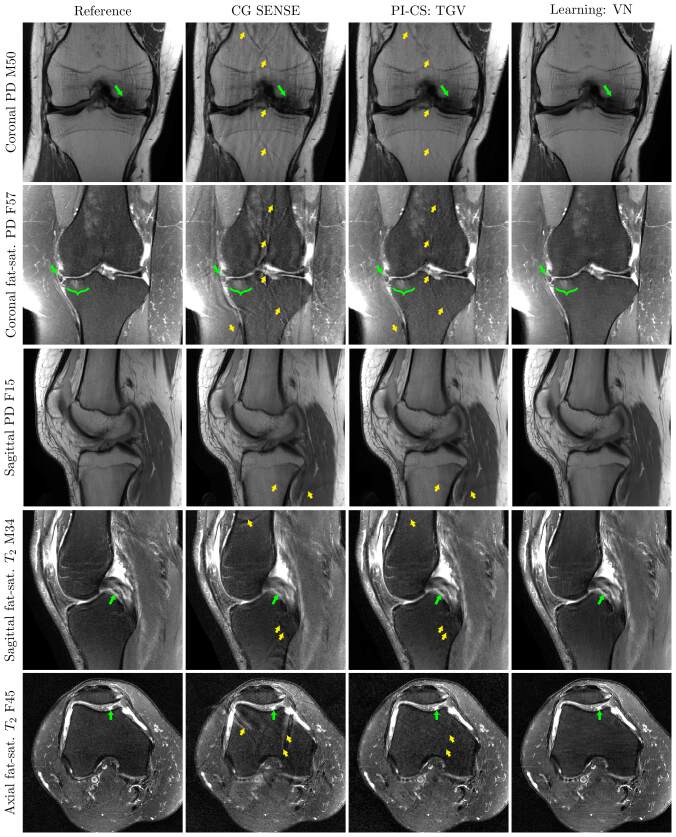 Learning a Variational Network for Reconstruction of Accelerated MRI ...