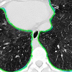 Progressive and Multi-Path Holistically Nested Neural Networks for Pathological Lung ...