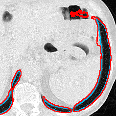 Progressive and Multi-Path Holistically Nested Neural Networks for Pathological Lung ...