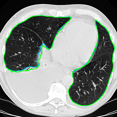 Progressive and Multi-Path Holistically Nested Neural Networks for Pathological Lung ...