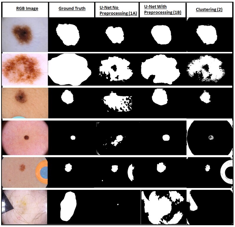 Skin Lesion Segmentation: U-Nets versus Clustering | DeepAI