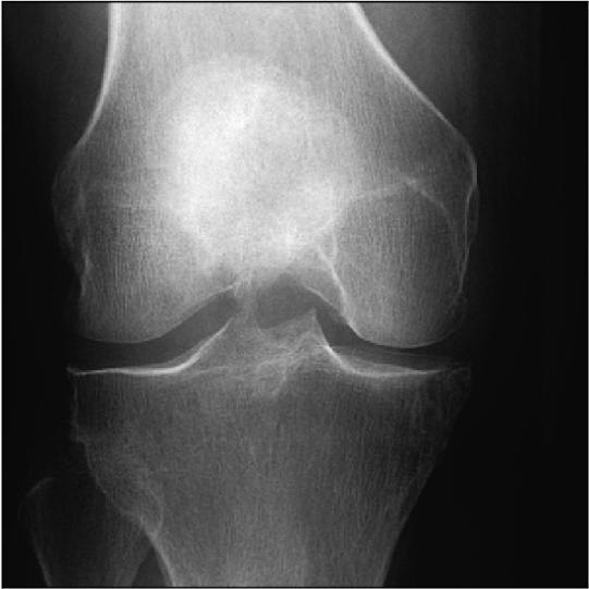 Automatic Knee Osteoarthritis Diagnosis from Plain Radiographs: A Deep ...