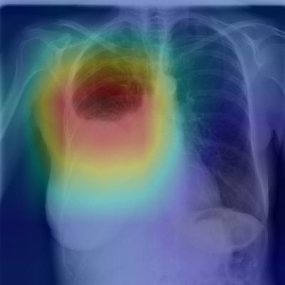CheXNet: Radiologist-Level Pneumonia Detection on Chest X-Rays with ...