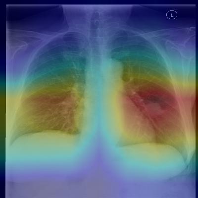 CheXNet: Radiologist-Level Pneumonia Detection on Chest X-Rays with Deep Learning | DeepAI