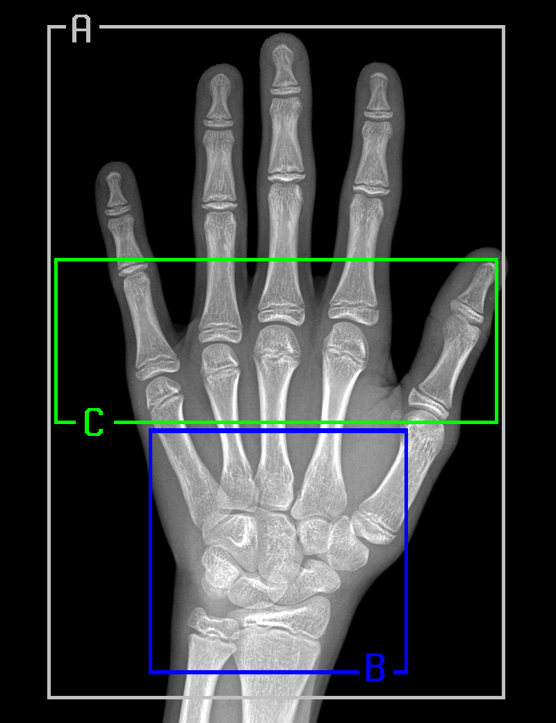 Pediatric Bone Age Assessment Using Deep Convolutional Neural Networks ...