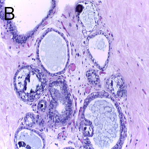 Classification of Breast Cancer Histology using Deep Learning | DeepAI