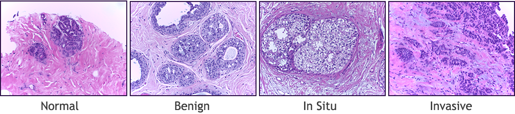 Two-Stage Convolutional Neural Network for Breast Cancer Histology ...