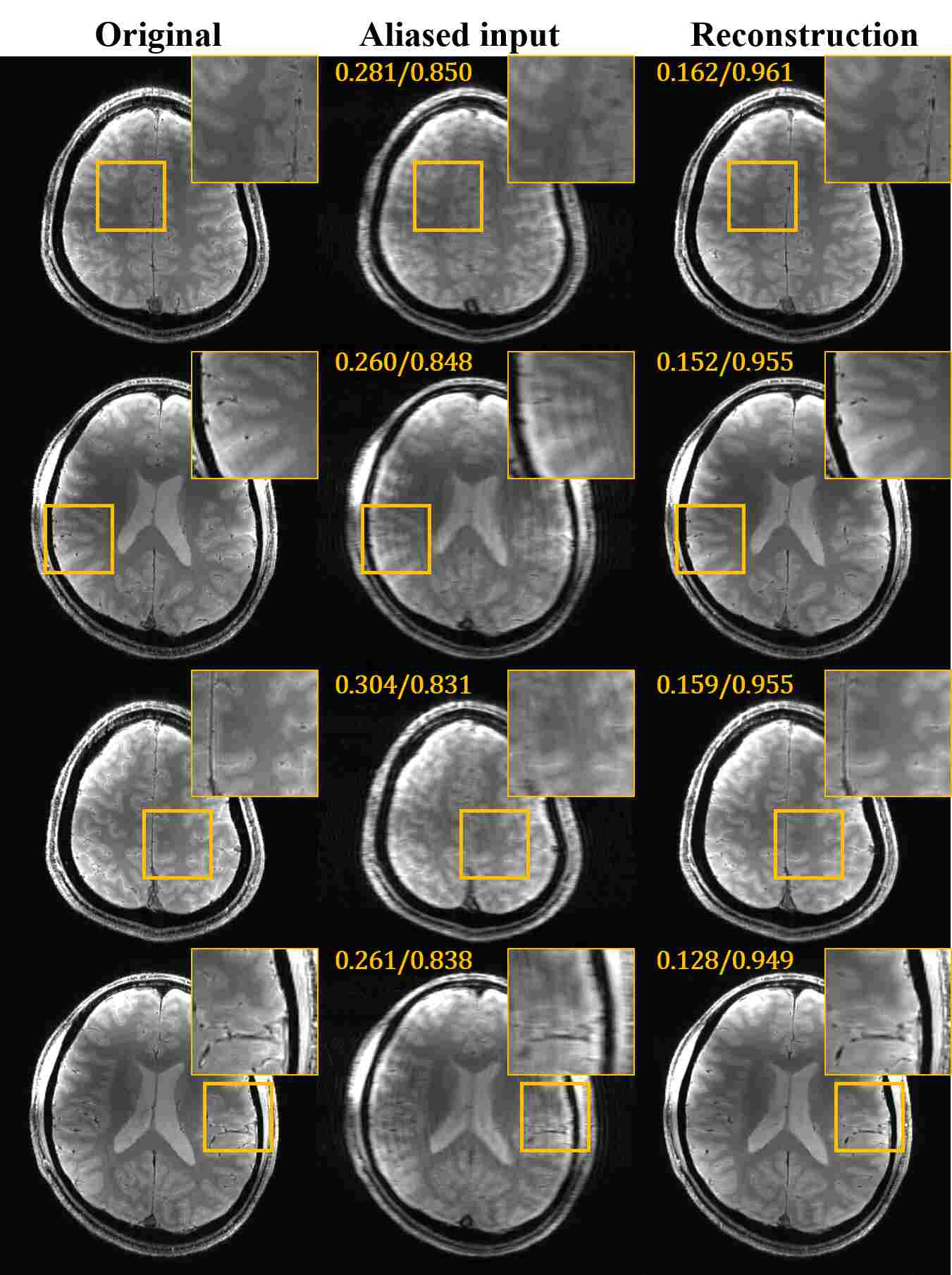 Deep Residual Learning for Accelerated MRI using Magnitude and Phase ...