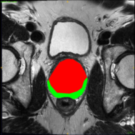 Automatic segmentation of prostate zones | DeepAI