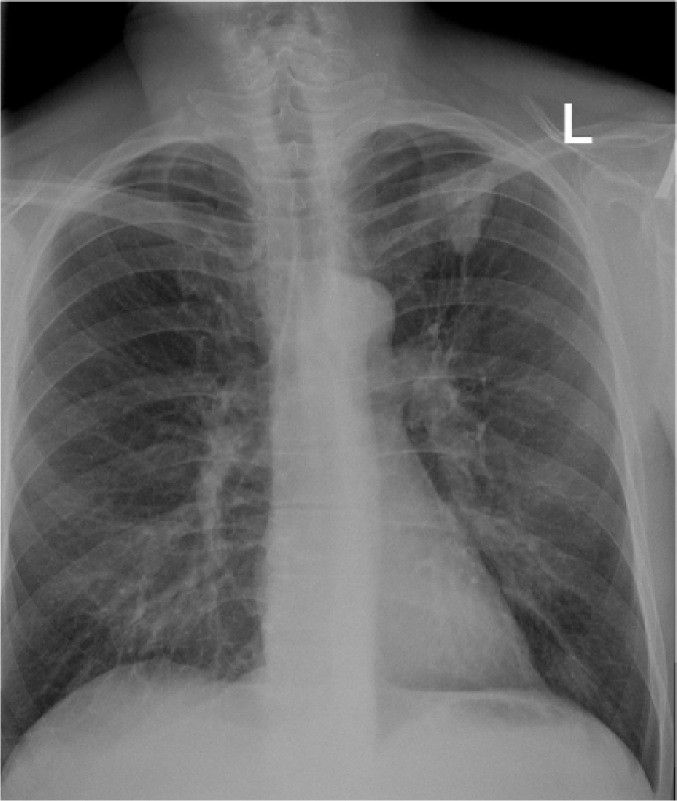 A Generic Approach to Lung Field Segmentation from Chest Radiographs ...