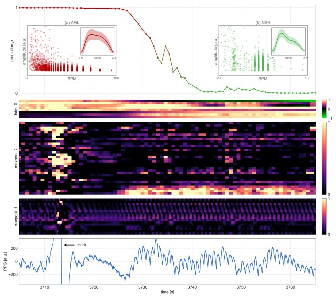 End-to-end Deep Learning from Raw Sensor Data: Atrial Fibrillation Detection using Wearables ...