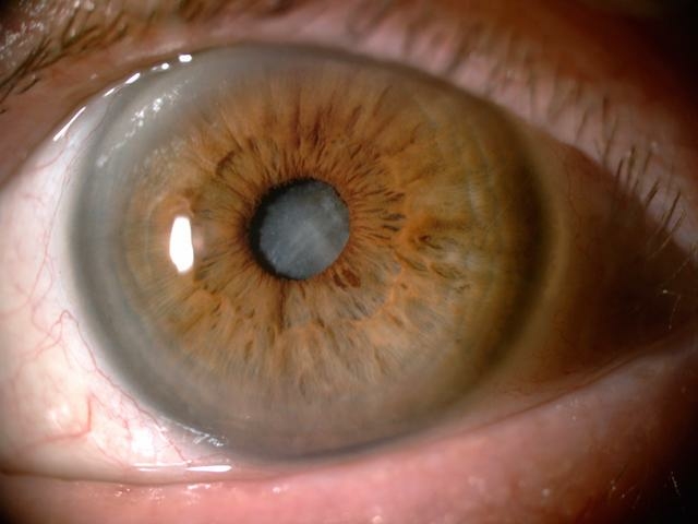 Iris recognition in cases of eye pathology | DeepAI