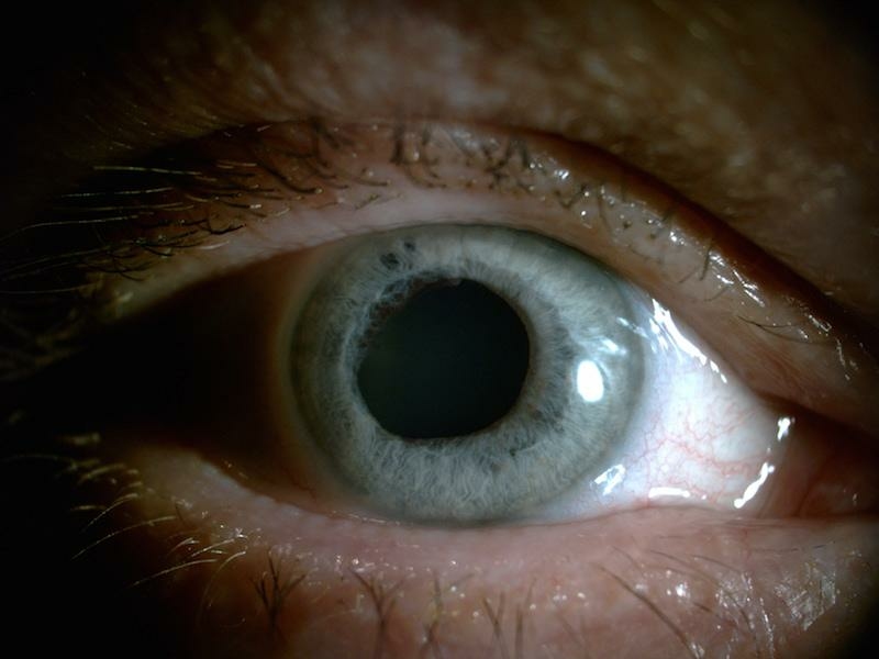 Iris recognition in cases of eye pathology | DeepAI