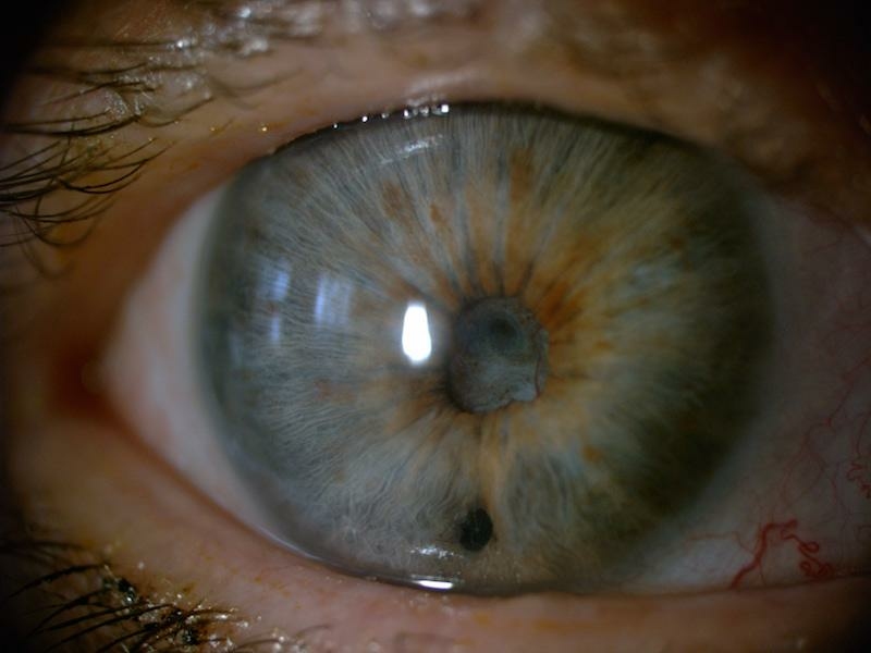 Iris recognition in cases of eye pathology | DeepAI