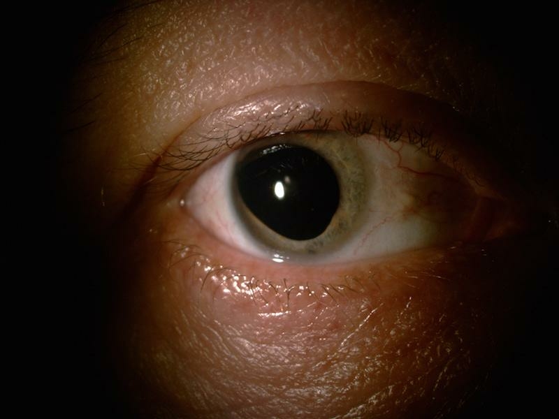 Iris recognition in cases of eye pathology | DeepAI