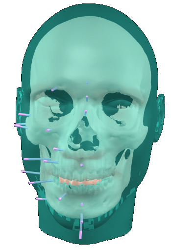 Superimposition-guided Facial Reconstruction from Skull | DeepAI