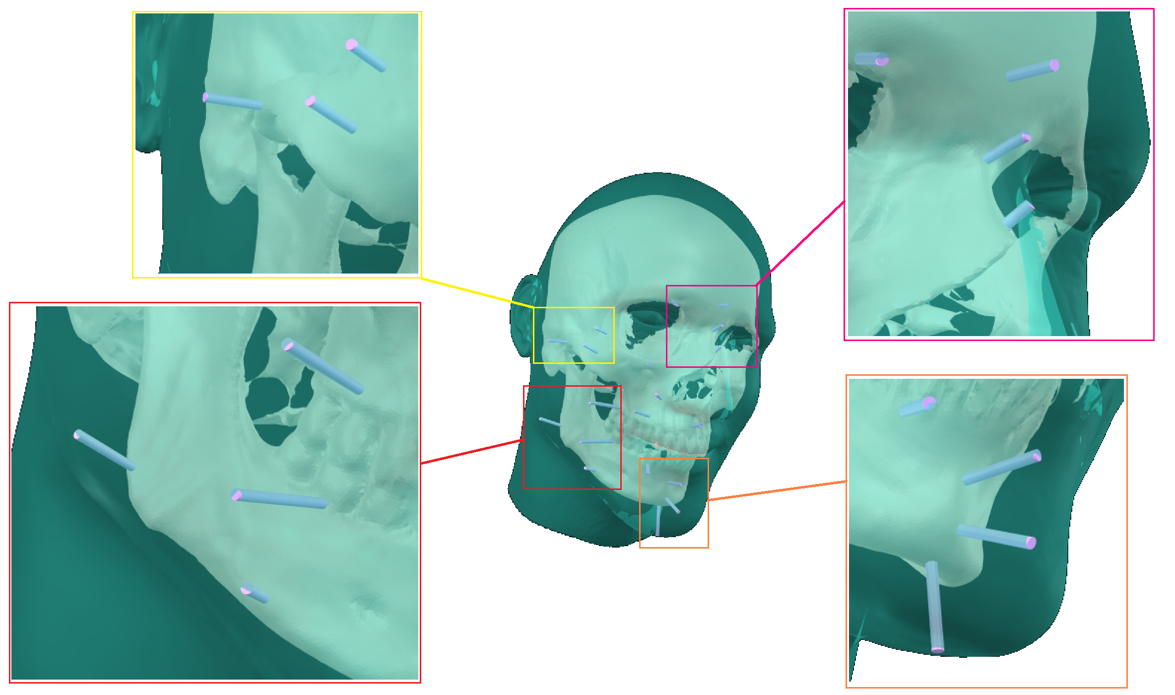 Superimposition-guided Facial Reconstruction from Skull | DeepAI