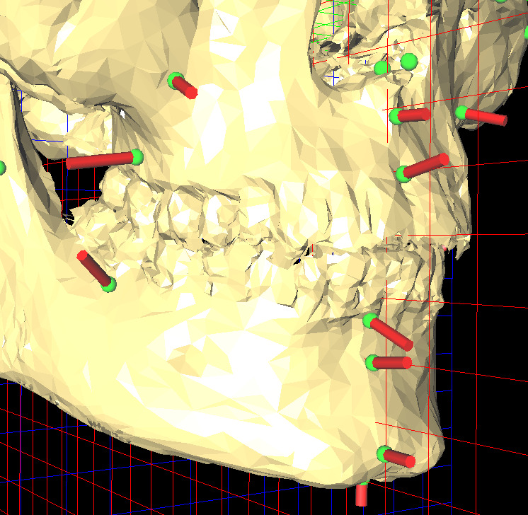 Superimposition-guided Facial Reconstruction from Skull | DeepAI