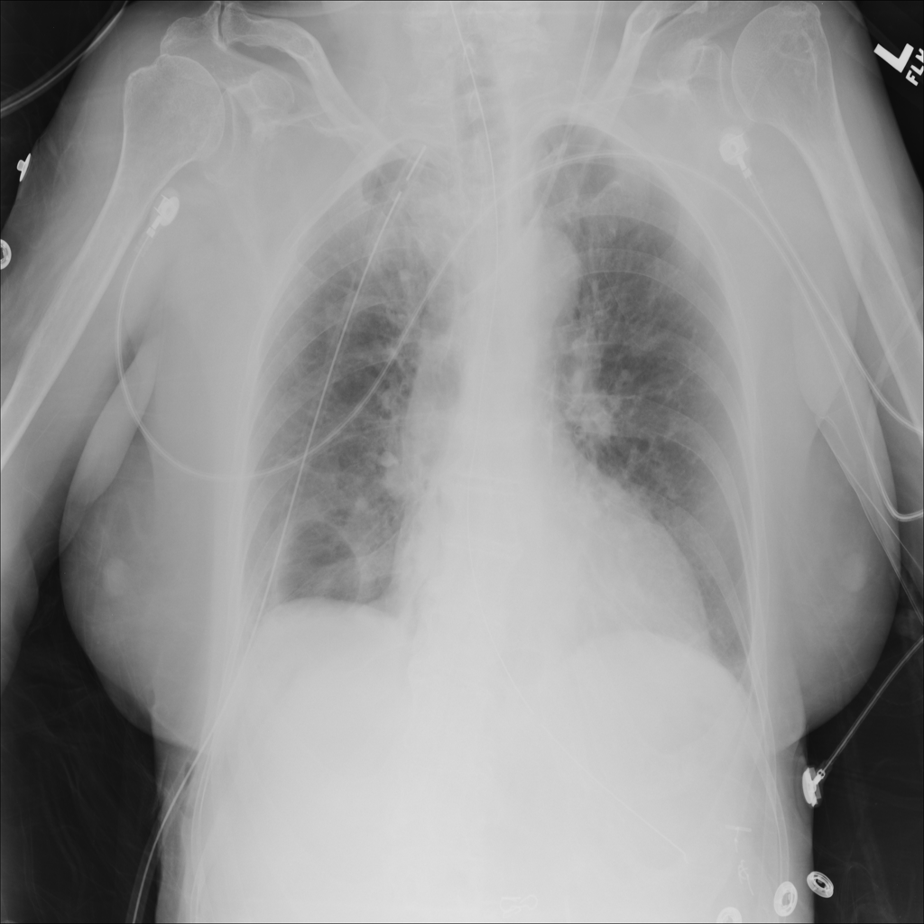 Chest X-Rays Image Inpainting with Context Encoders | DeepAI