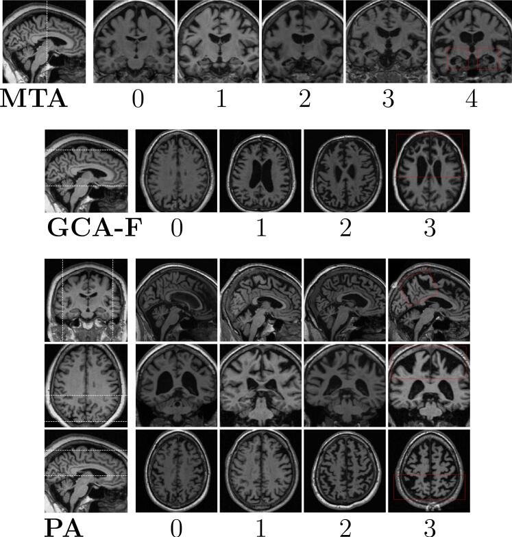 AVRA: Automatic Visual Ratings of Atrophy from MRI images using Recurrent Convolutional Neural ...