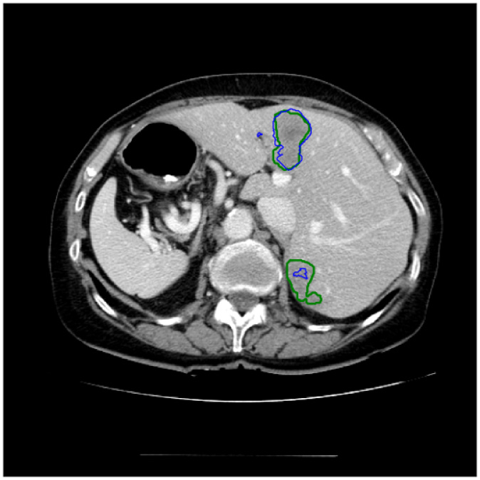 The Liver Tumor Segmentation Benchmark (LiTS) | DeepAI