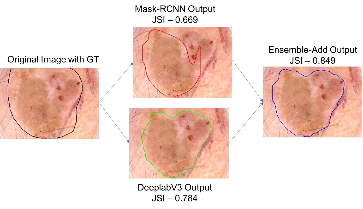 Automatic Lesion Boundary Segmentation in Dermoscopic Images with Ensemble Deep Learning Methods ...