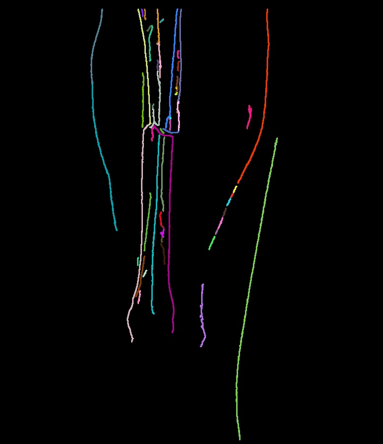 Long Bone Fracture Detection Using Artificial Neural Networks Based On