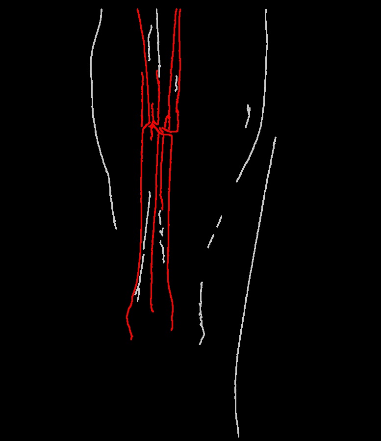 Long Bone Fracture Detection Using Artificial Neural Networks Based On Contour Features Of X Ray