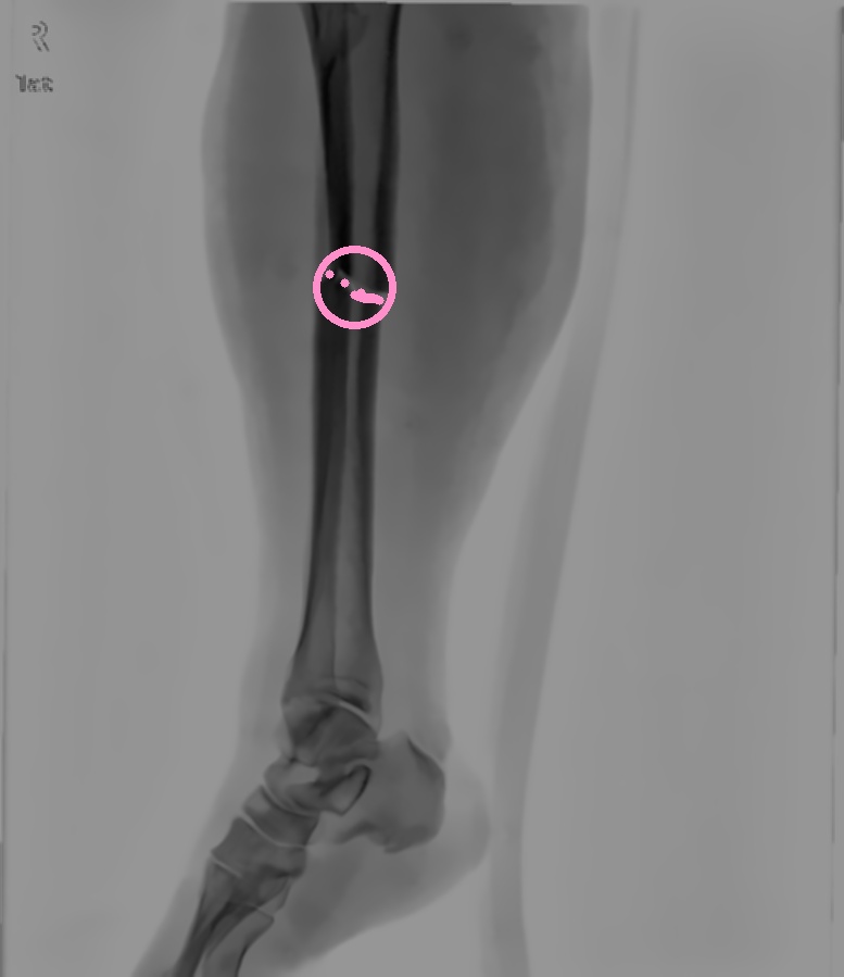 Long Bone Fracture Detection Using Artificial Neural Networks Based On