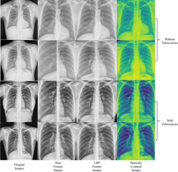 TBNet:Pulmonary Tuberculosis Diagnosing System using Deep Neural ...