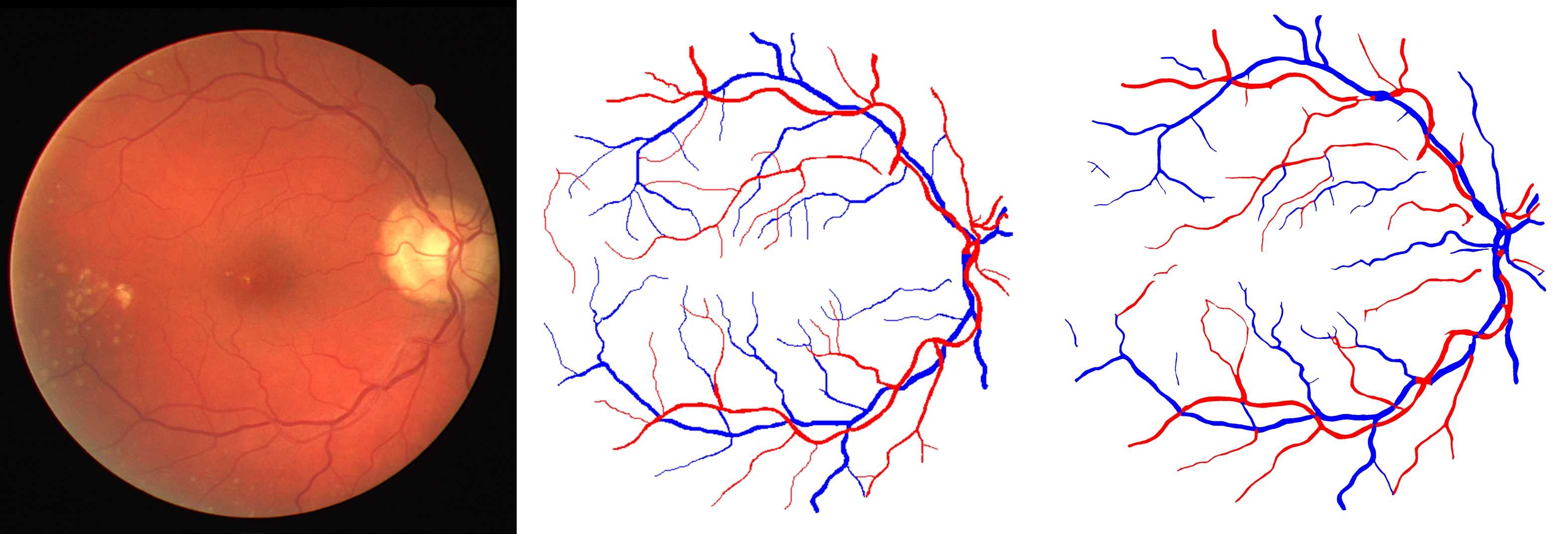 Joint segmentation and classification of retinal arteries/veins from ...