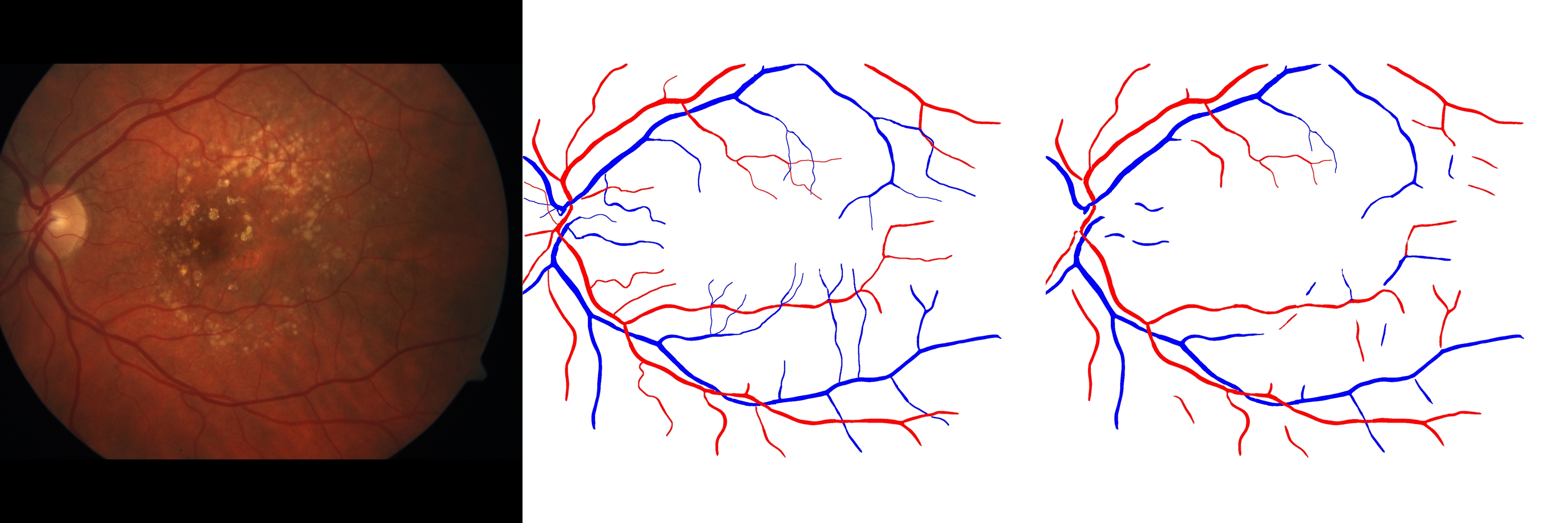 Joint segmentation and classification of retinal arteries/veins from fundus images | DeepAI