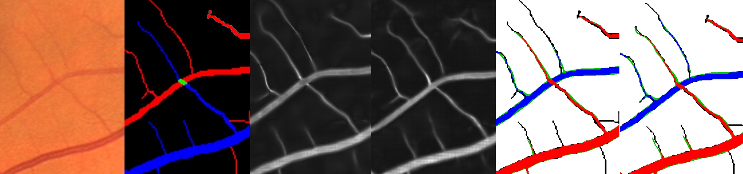 Joint segmentation and classification of retinal arteries/veins from fundus images | DeepAI