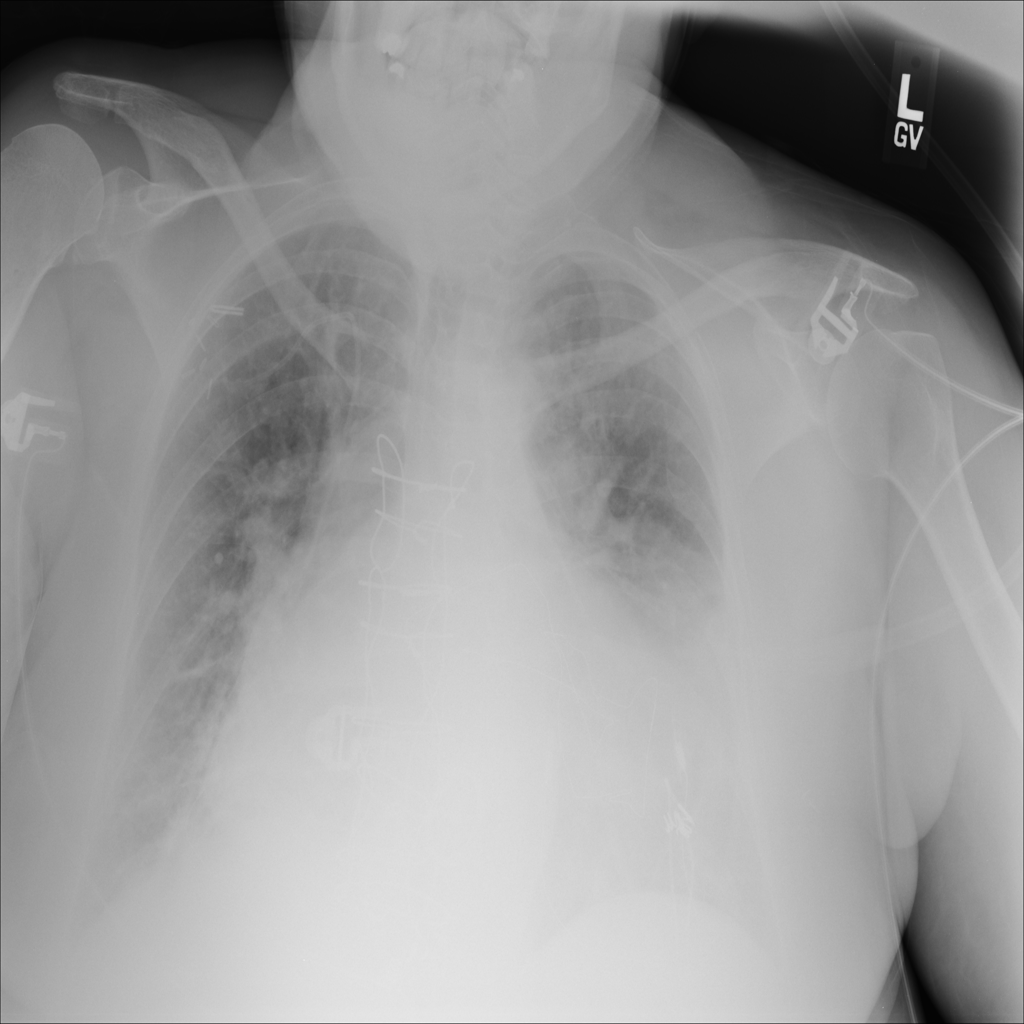 Identifying disease-free chest X-ray images with deep transfer learning ...