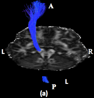 Corticospinal Tract (CST) reconstruction based on fiber orientation ...