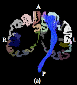 Corticospinal Tract (CST) reconstruction based on fiber orientation ...