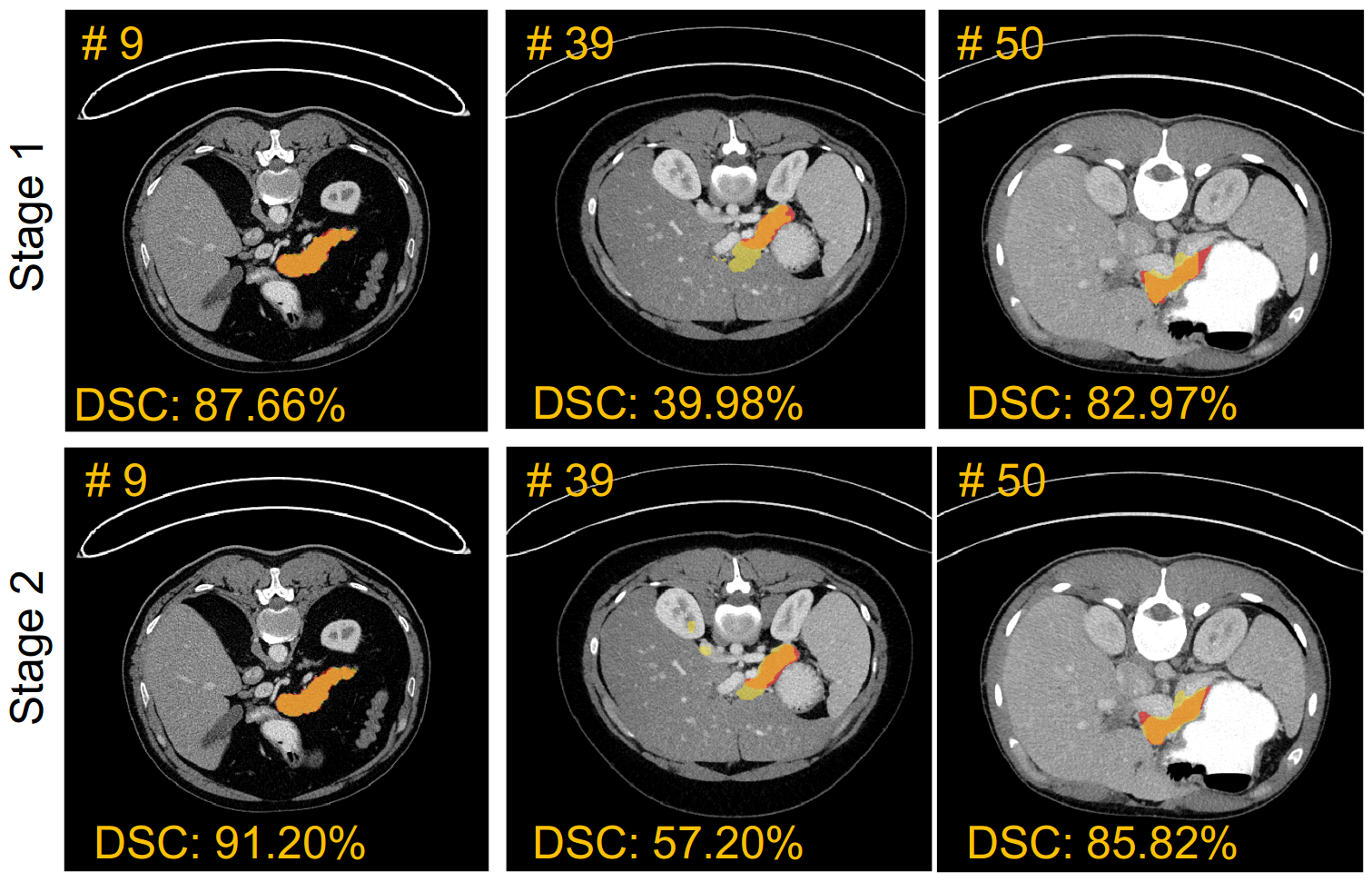 Fully Automated Pancreas Segmentation with Two-stage 3D Convolutional ...
