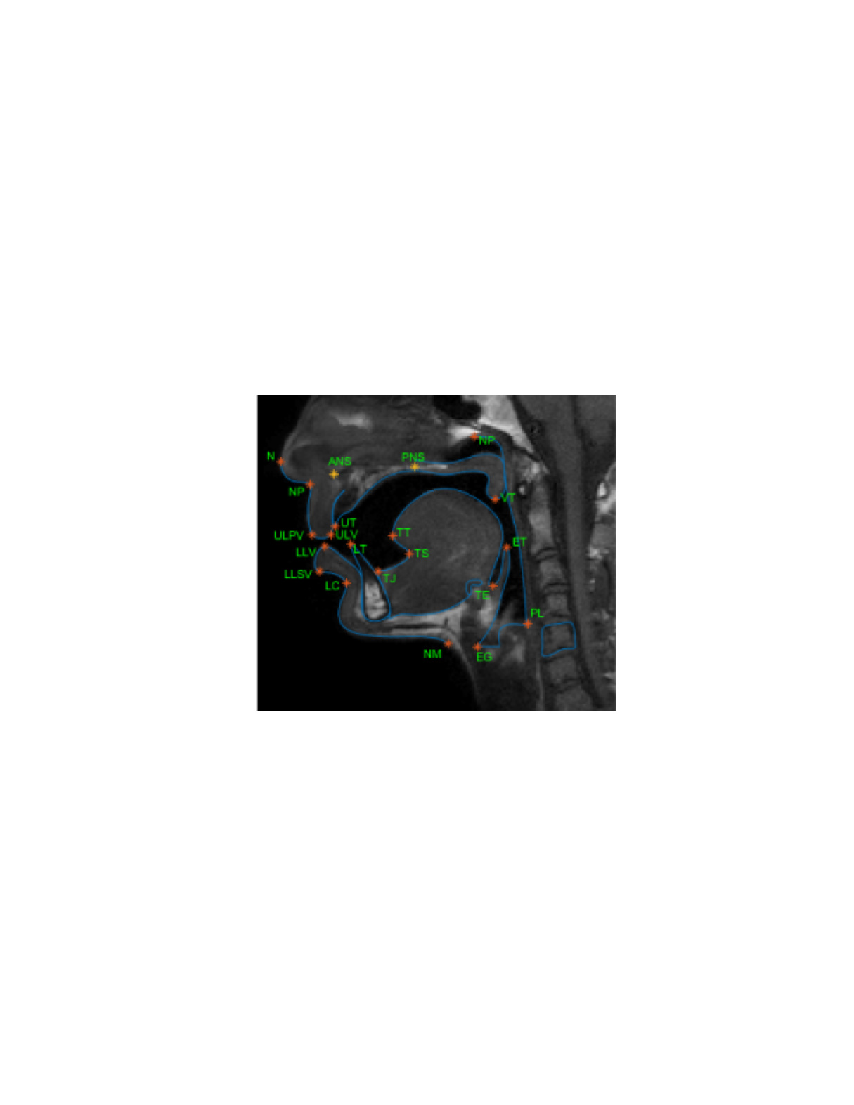 Automatic vocal tract landmark localization from midsagittal MRI data ...